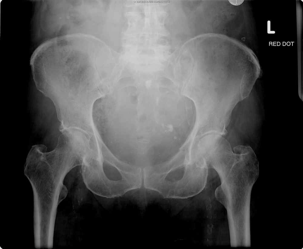 Pubic Ramus 5082